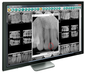 digital-radiograph-picture-for-the-web-site - endodontics | bartram park